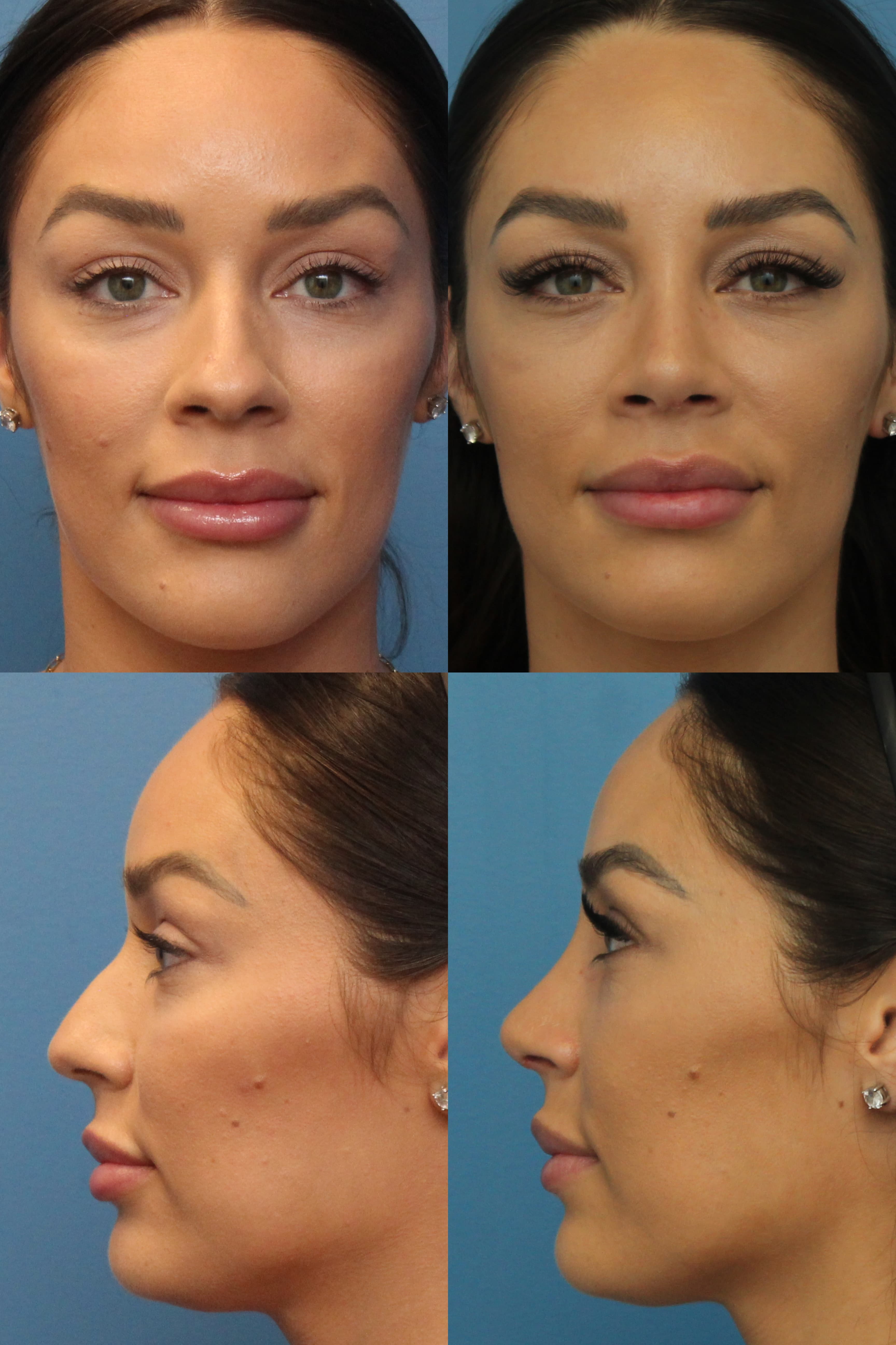 Good Rhinoplasty Before And After