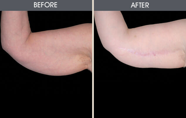 Fibroma Arm