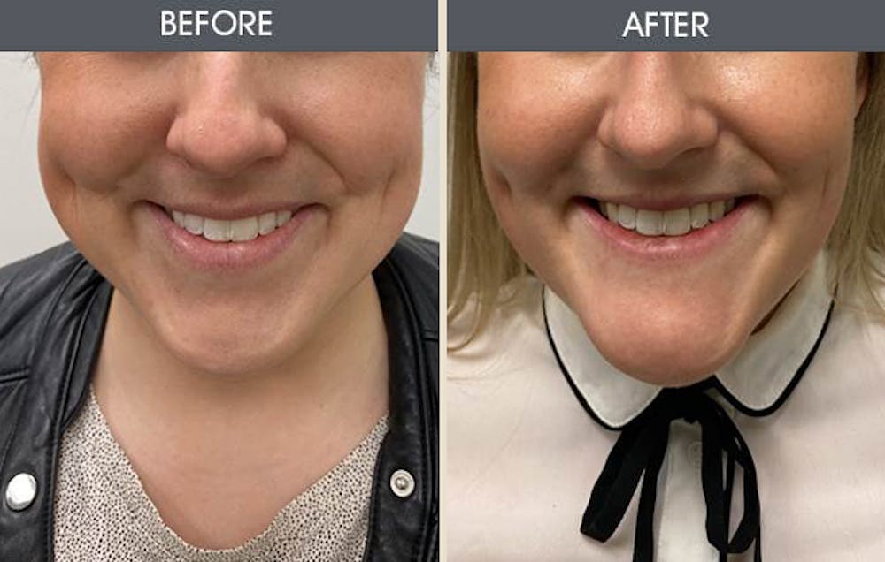 Patient 154361167 Sliding Genioplasty Gallery Before And After Photos Dr Darrick E Antell Md