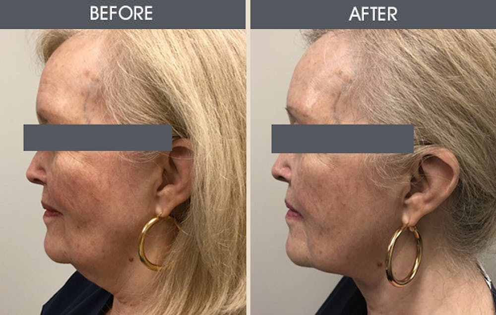 Patient 324291 Submental Liposuction Before And After Photos Dr