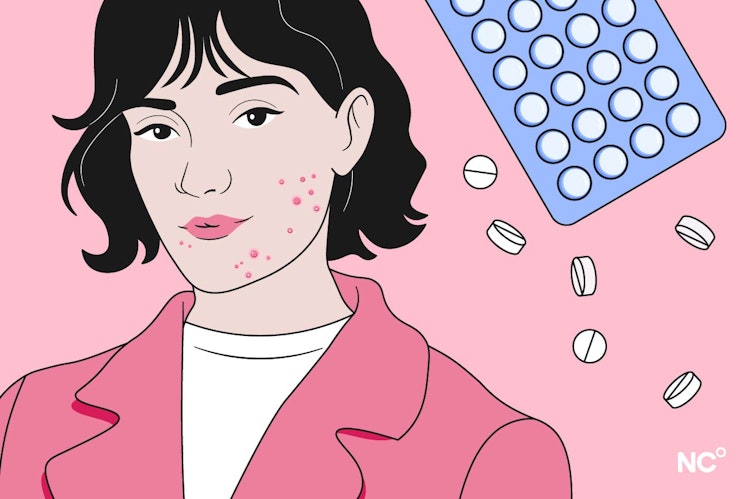 Acne During Ovulation? Why It Happens & How To Fix It