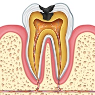 Charleston SC How Even Small Cavities Can Lead To Tooth LossSocial Charleston SC How Even Small Cavities Can Lead To Tooth LossSocial