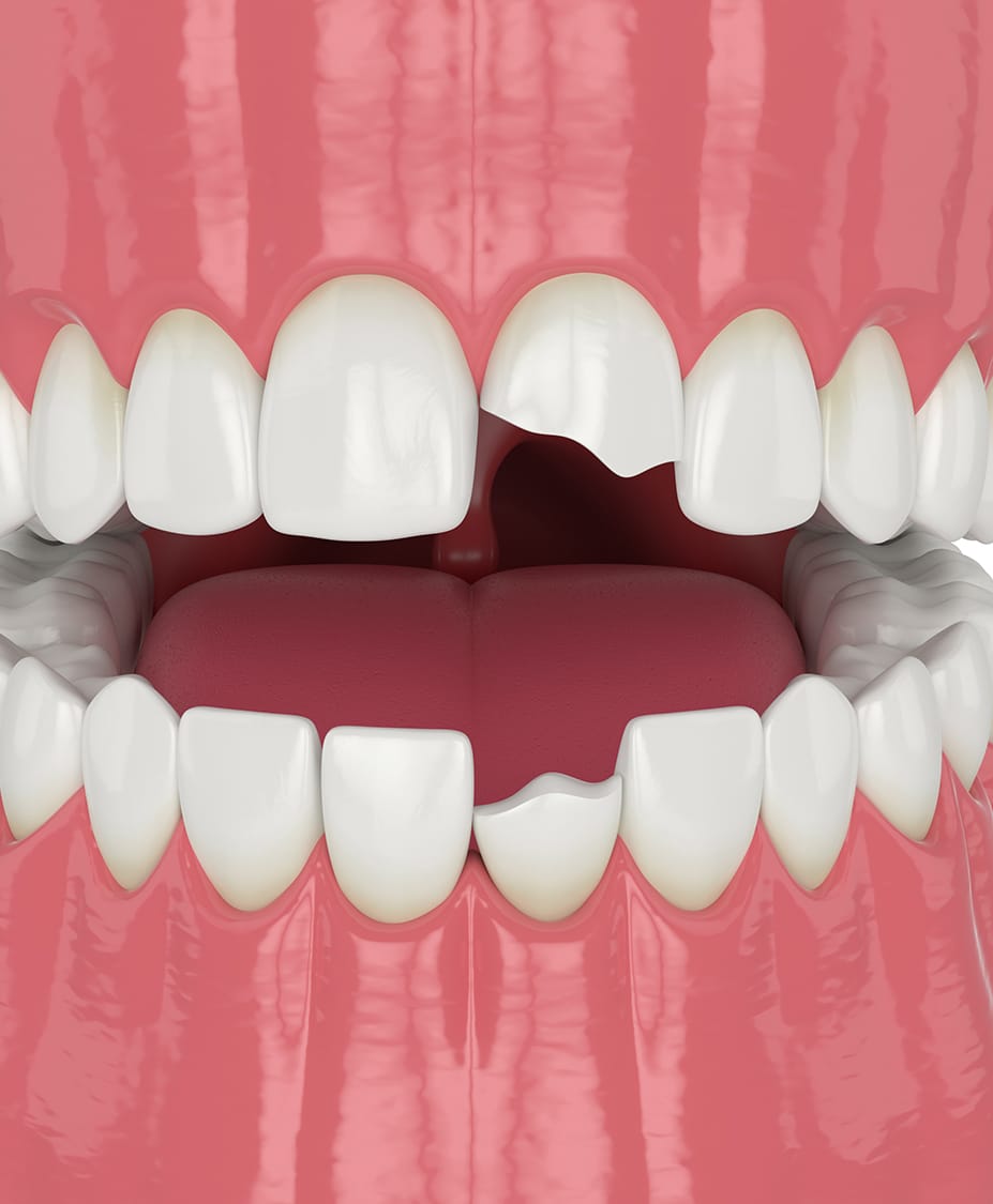 Chipped Teeth | Charleston Center For Cosmetic Dentistry