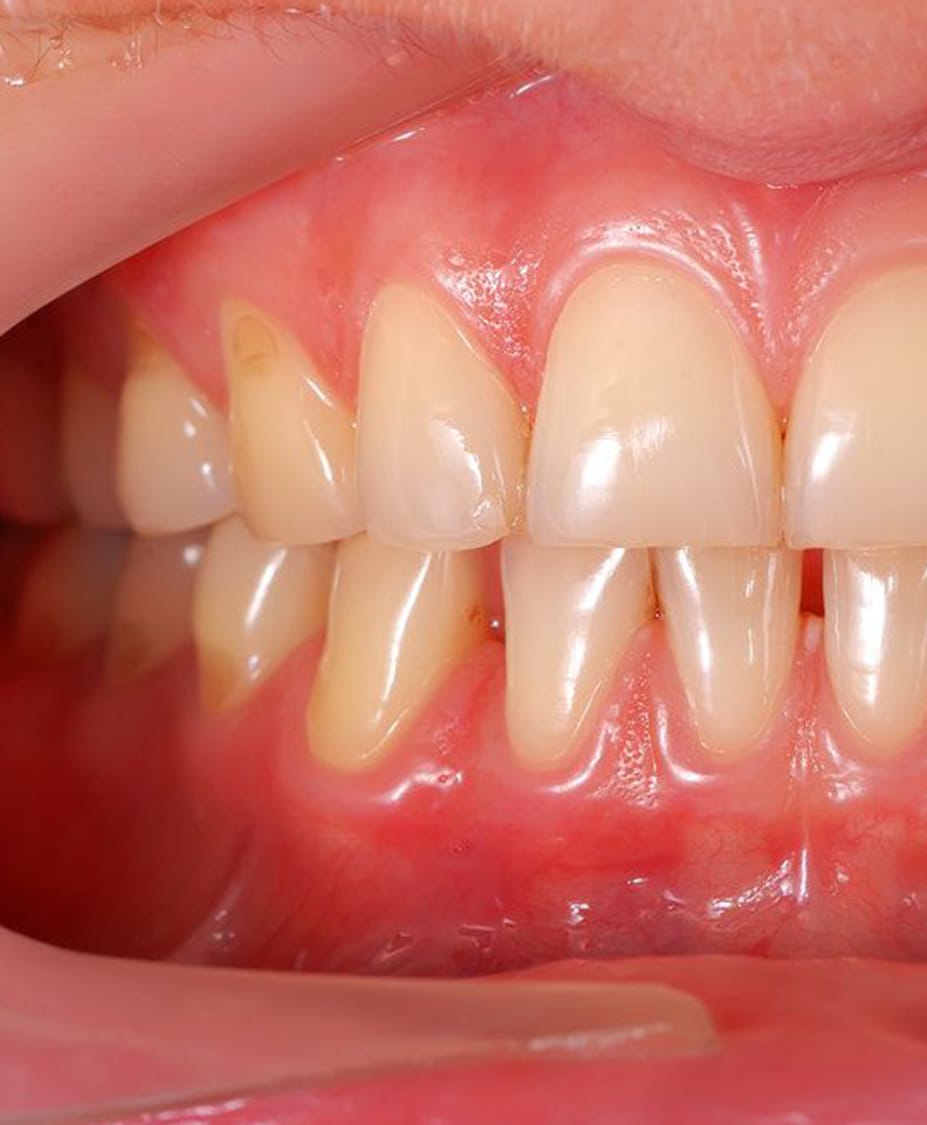 Gum Contouring - Charleston, SC - Hilton Head, SC - Myrtle Beach, SC