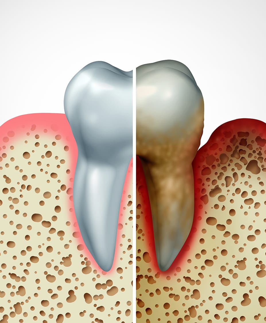 Gingivitis | Charleston Center For Cosmetic Dentistry