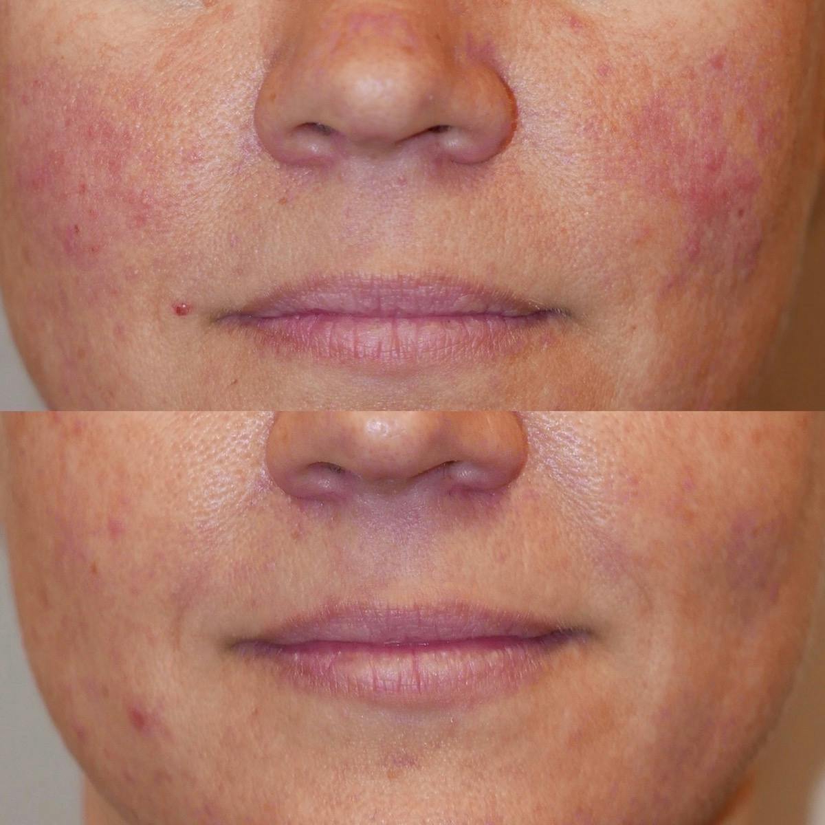 V Beam Gallery | Skin Matrx