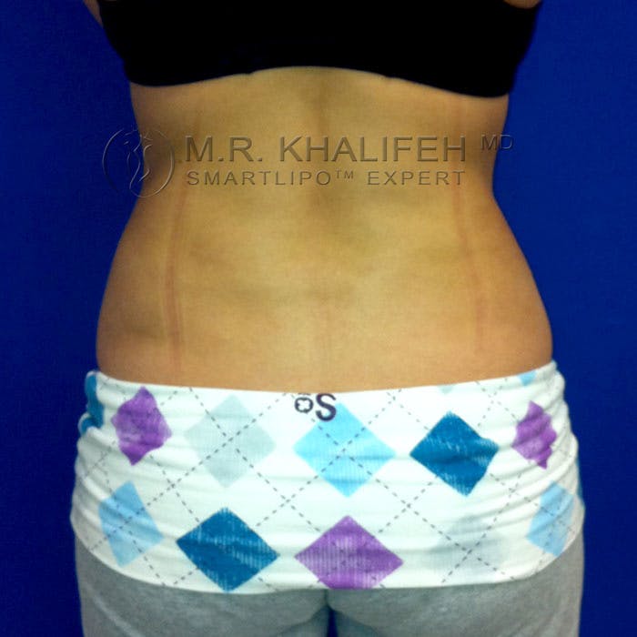 flank-lower back liposuction Gallery | DC Cosmetics