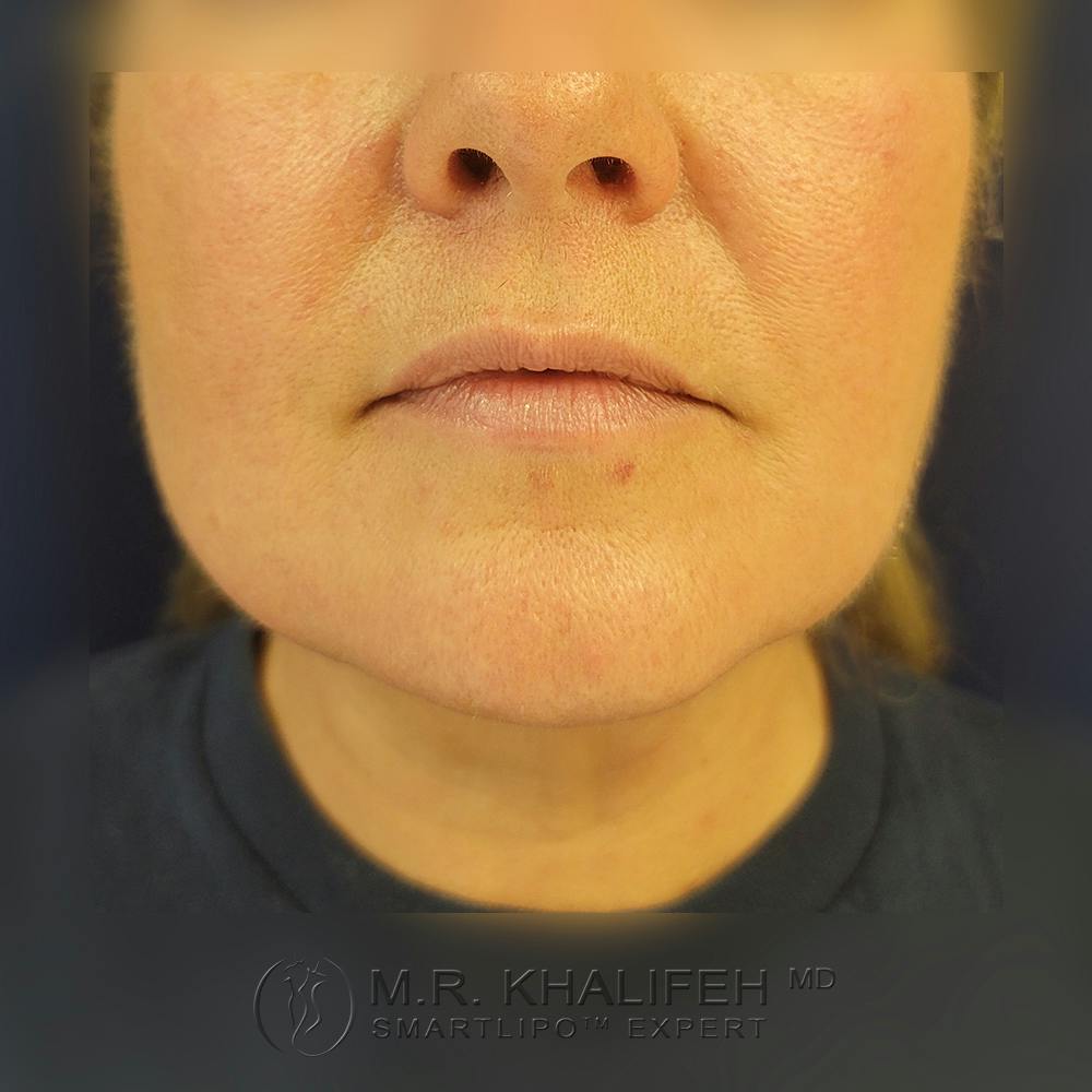 Buccal Fat Pad Excision Before & After Photos | DC Cosmetics