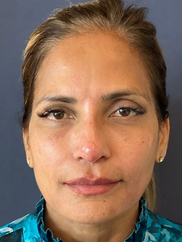 Patient 149097707 | Dermal Fillers Before and After | Alizadeh ...