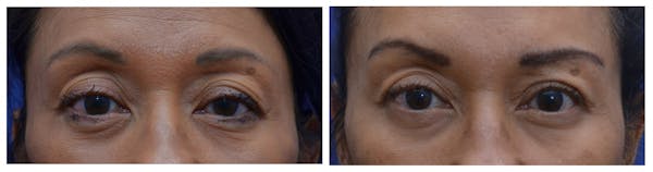Eyelid Surgery Gallery | Tansavatdi Cosmetic & Reconstructive Surgery