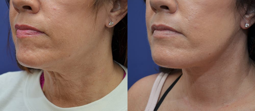 Patient 5930610 | Neck Lift Gallery | Tansavatdi Cosmetic ...