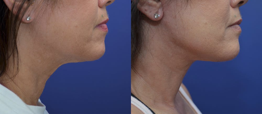 Patient 5930610 | Neck Lift Gallery | Tansavatdi Cosmetic ...