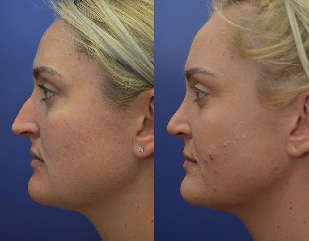 Patient 5724943 | Rhinoplasty Gallery | Tansavatdi Cosmetic ...