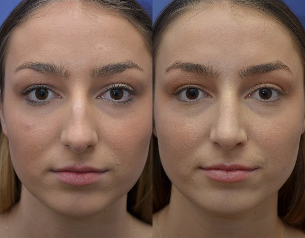 Patient 5724935 | Rhinoplasty Gallery | Tansavatdi Cosmetic ...
