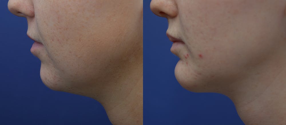Patient 19339345 Lip Augmentation Gallery Tansavatdi Facial Plastic