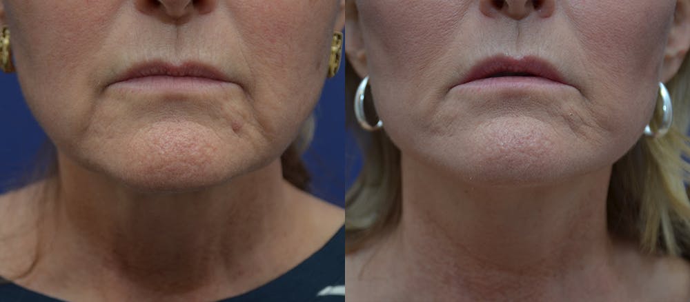 Patient 45664910 | Neck Lift Gallery | Tansavatdi Cosmetic ...