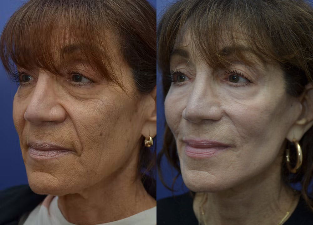 Patient 121814360 Alarplasty Before And After Photos Tansavatdi