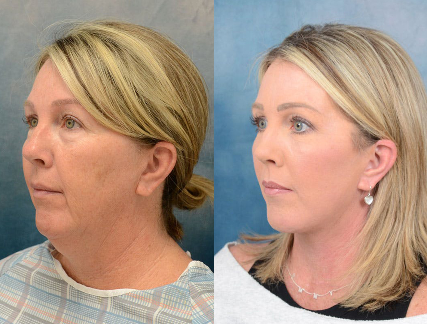 Deep Plane Facelift Scottsdale Facelift Specialist In Scottsdale
