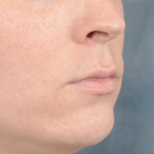 Patient 120812982 Lip Lift Before And After Photos Starkman Facial