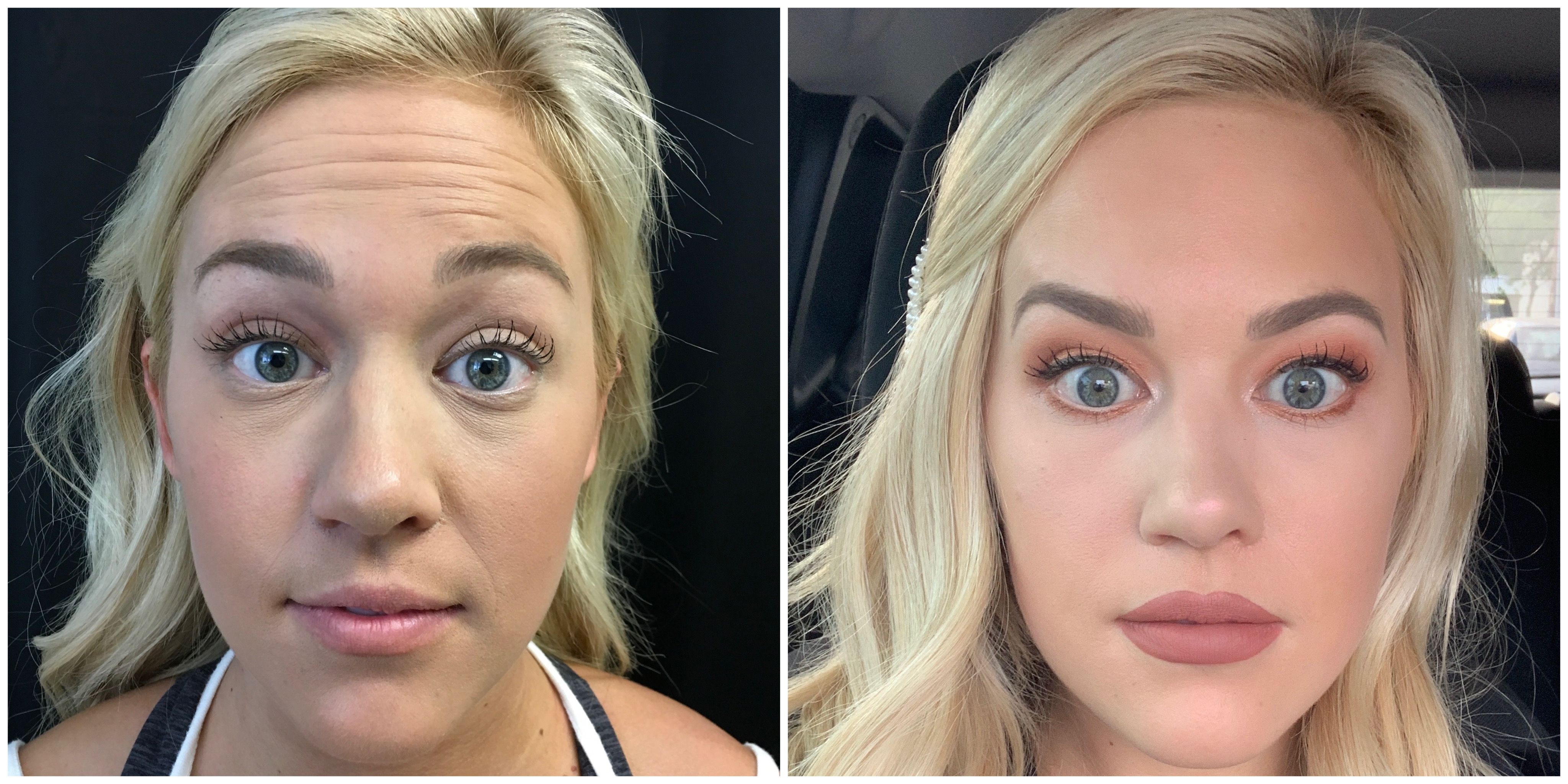 Blepharospasm Botox Before And After