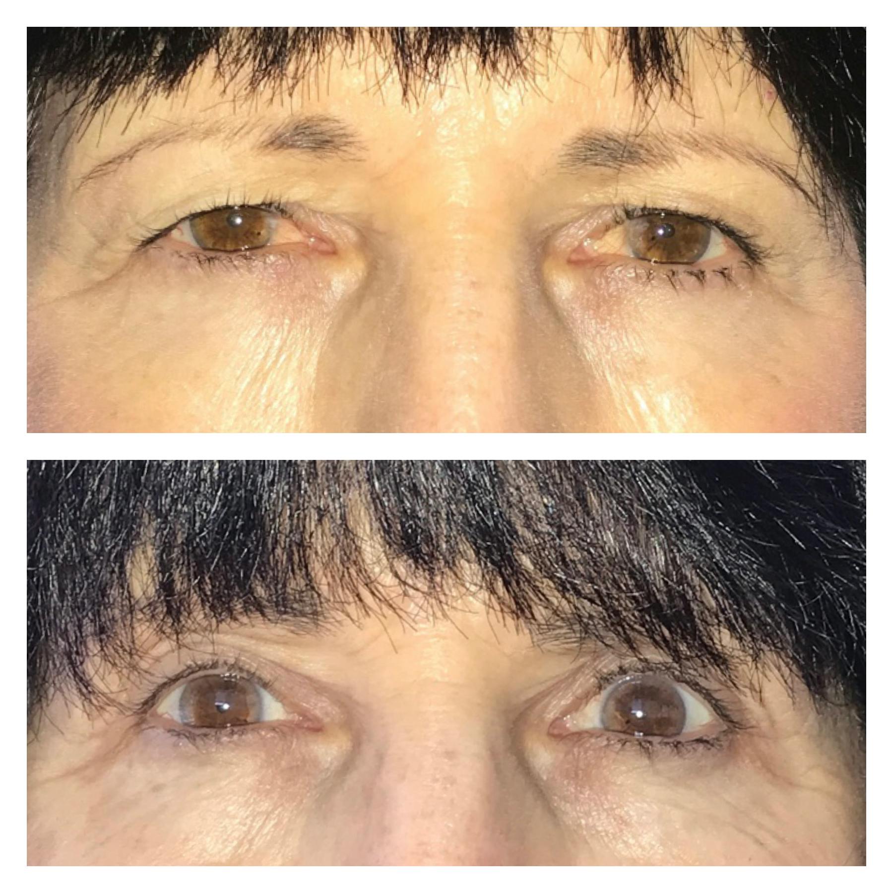 Ptosis Before & After Photos | Austin Face & Body | Page 1