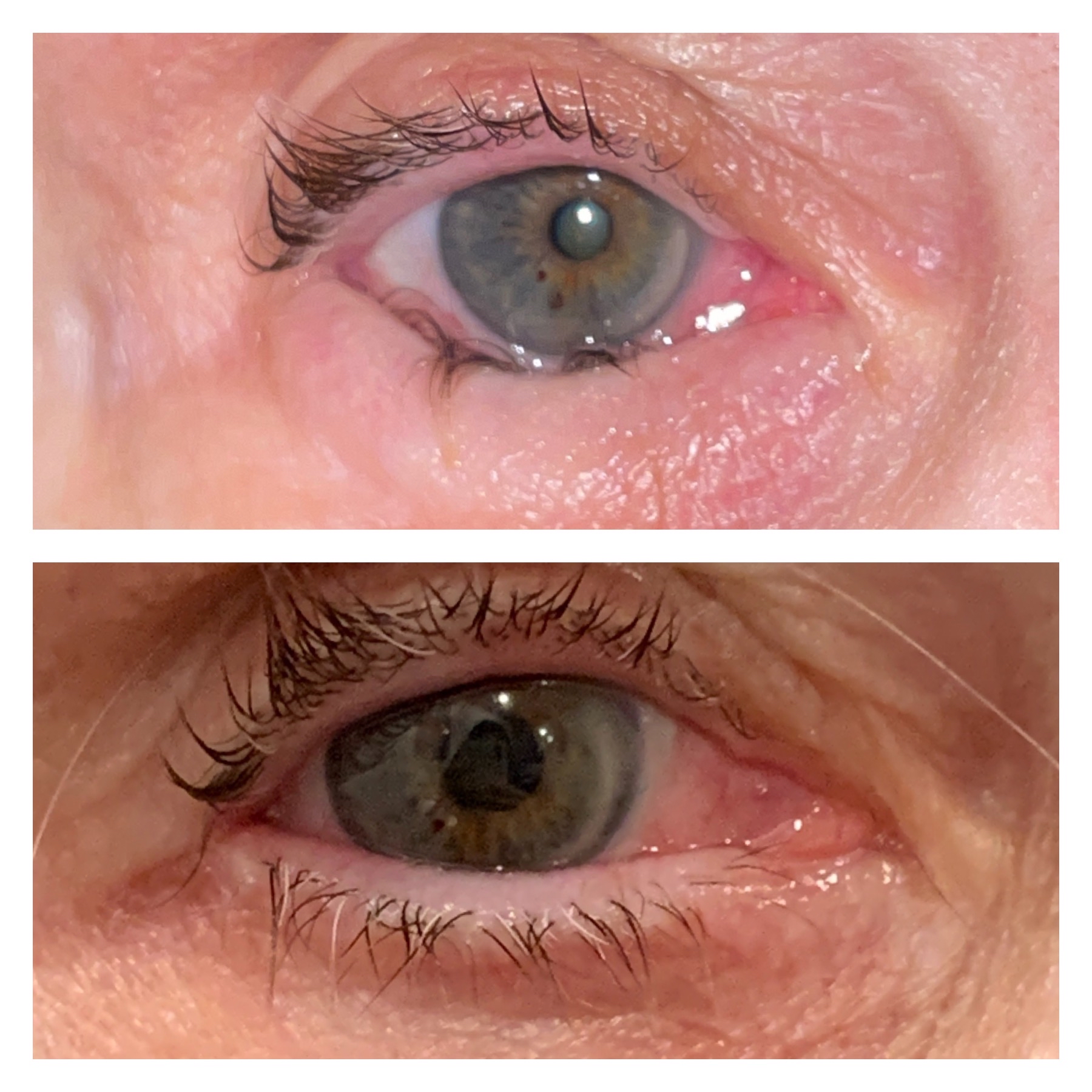 Step By Step Procedure For Ectropion