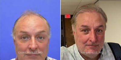 Patient 144658912 | Hair Restoration Before & After Photos | Austin ...