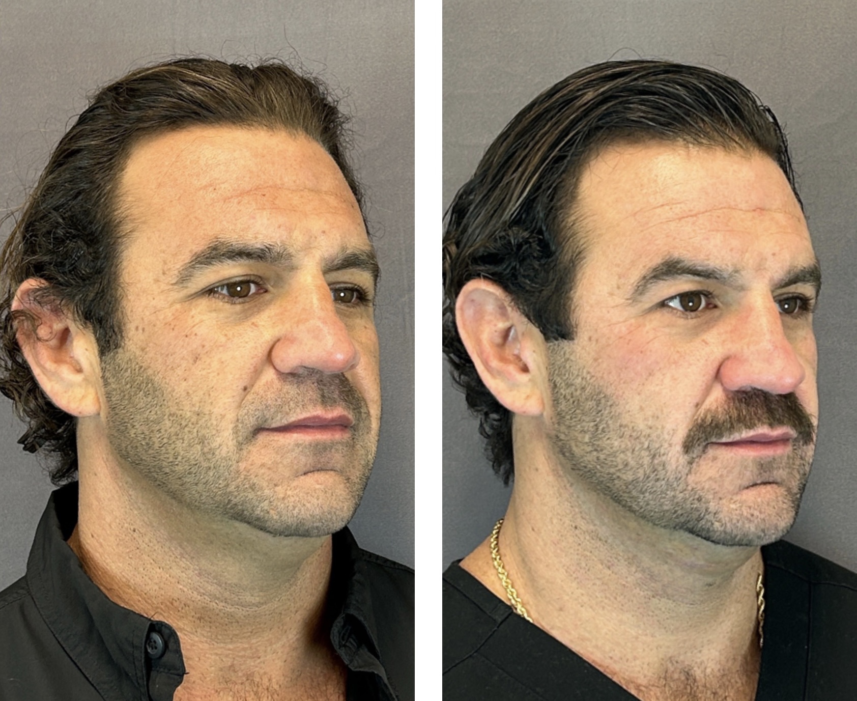 Labiaplasty Before And After Photo Gallery