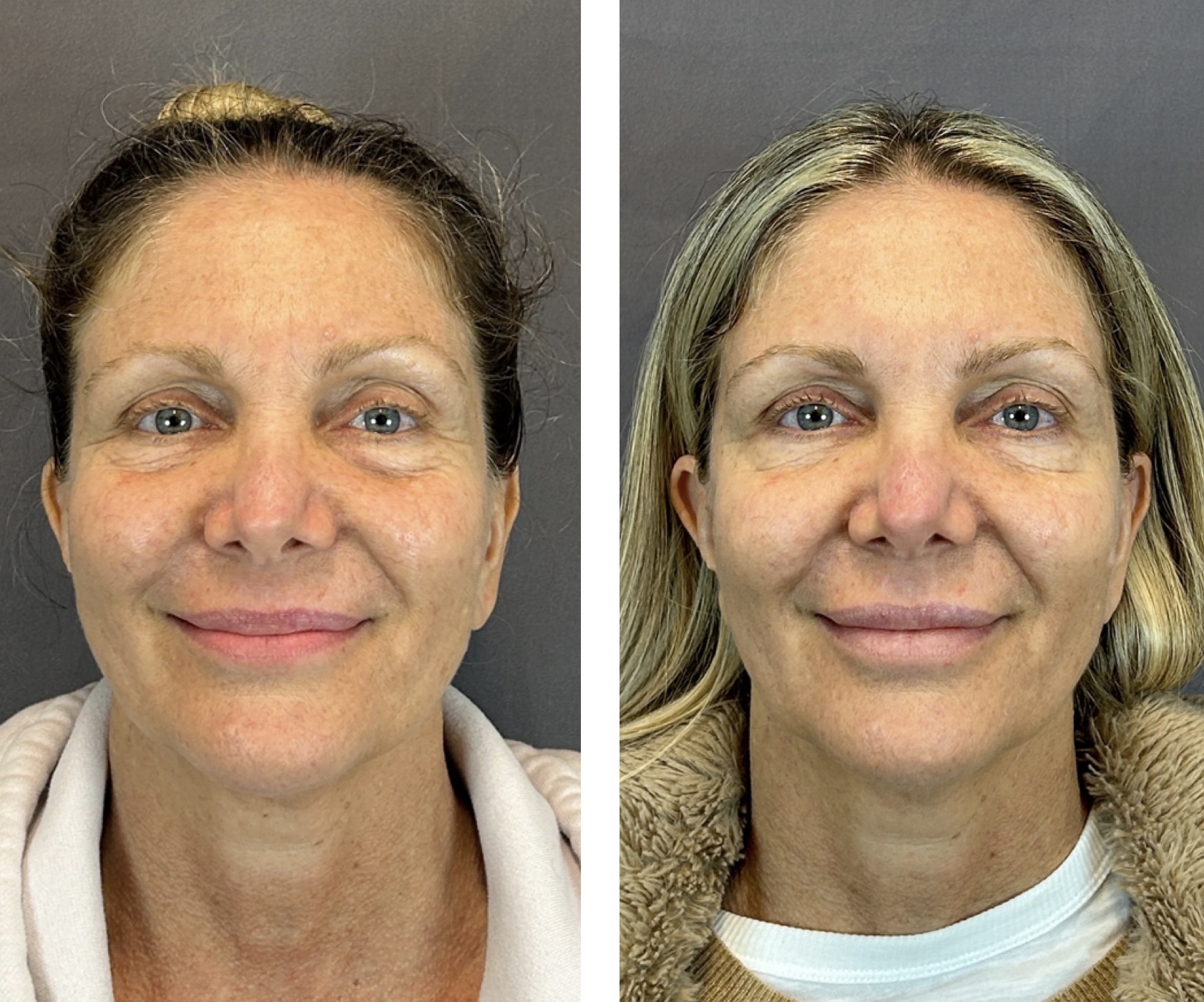 Blepharospasm Botox Before And After