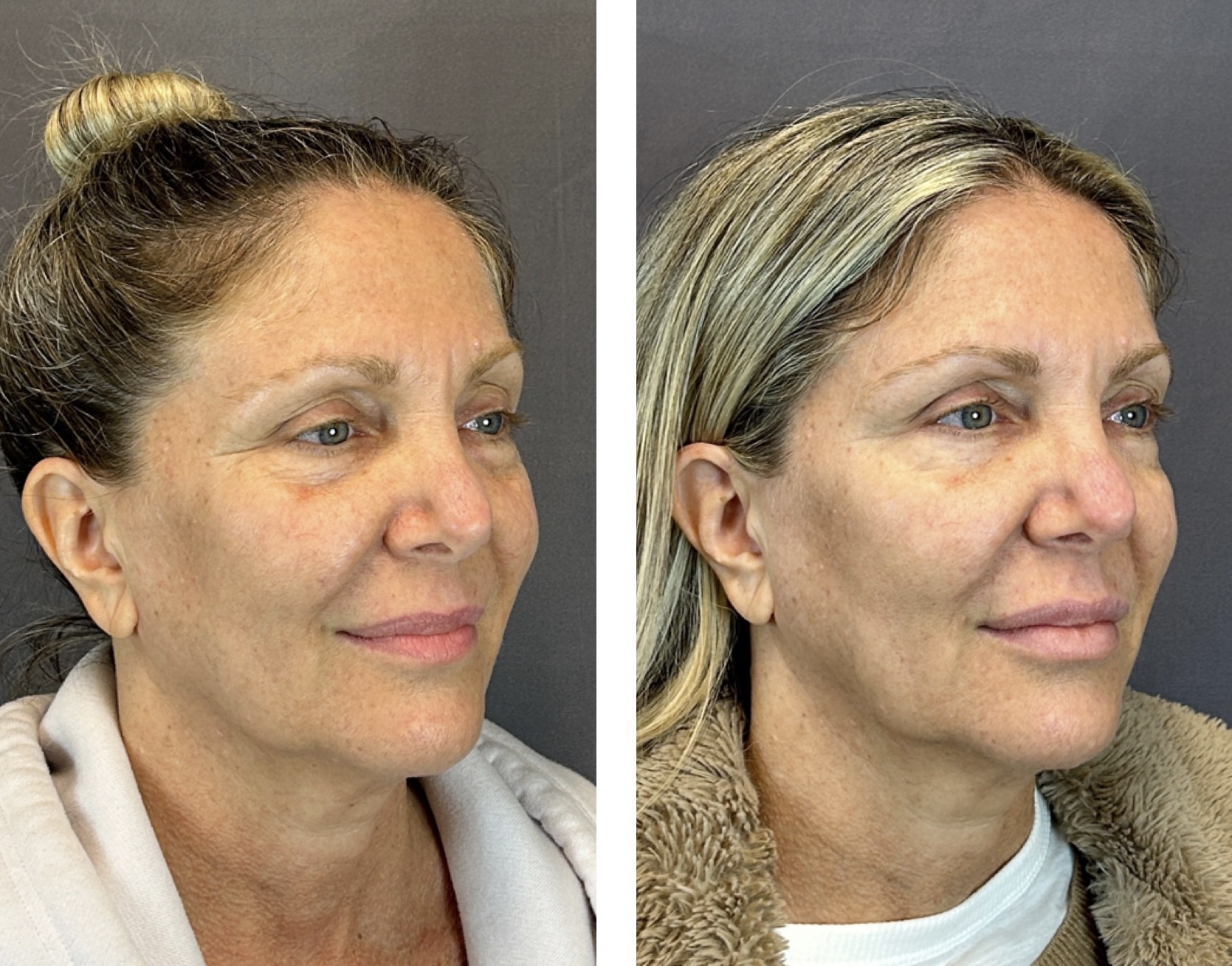 Wrinkled Face Before And After