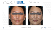 Moxi Laser Austin Face Body