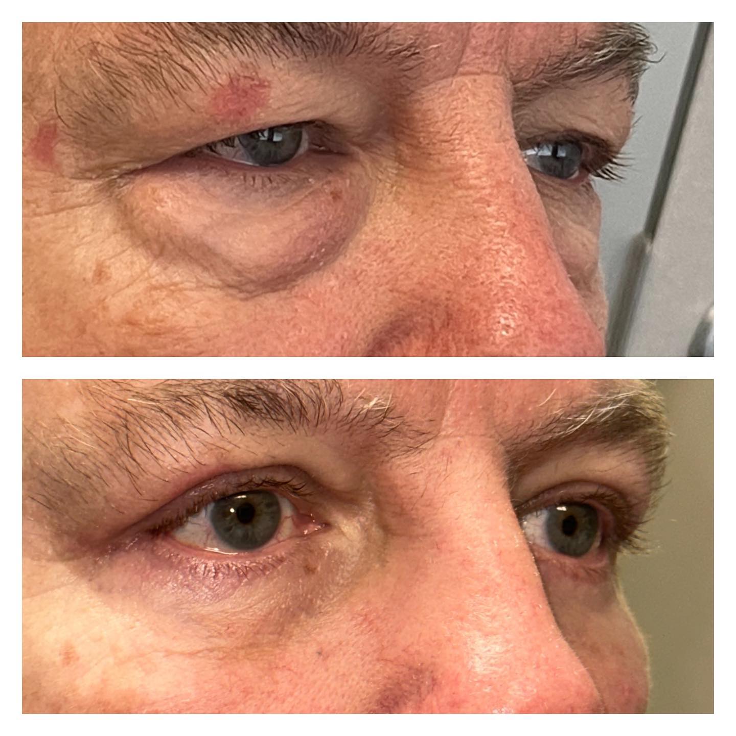 Ectropion After Lower Blepharoplasty