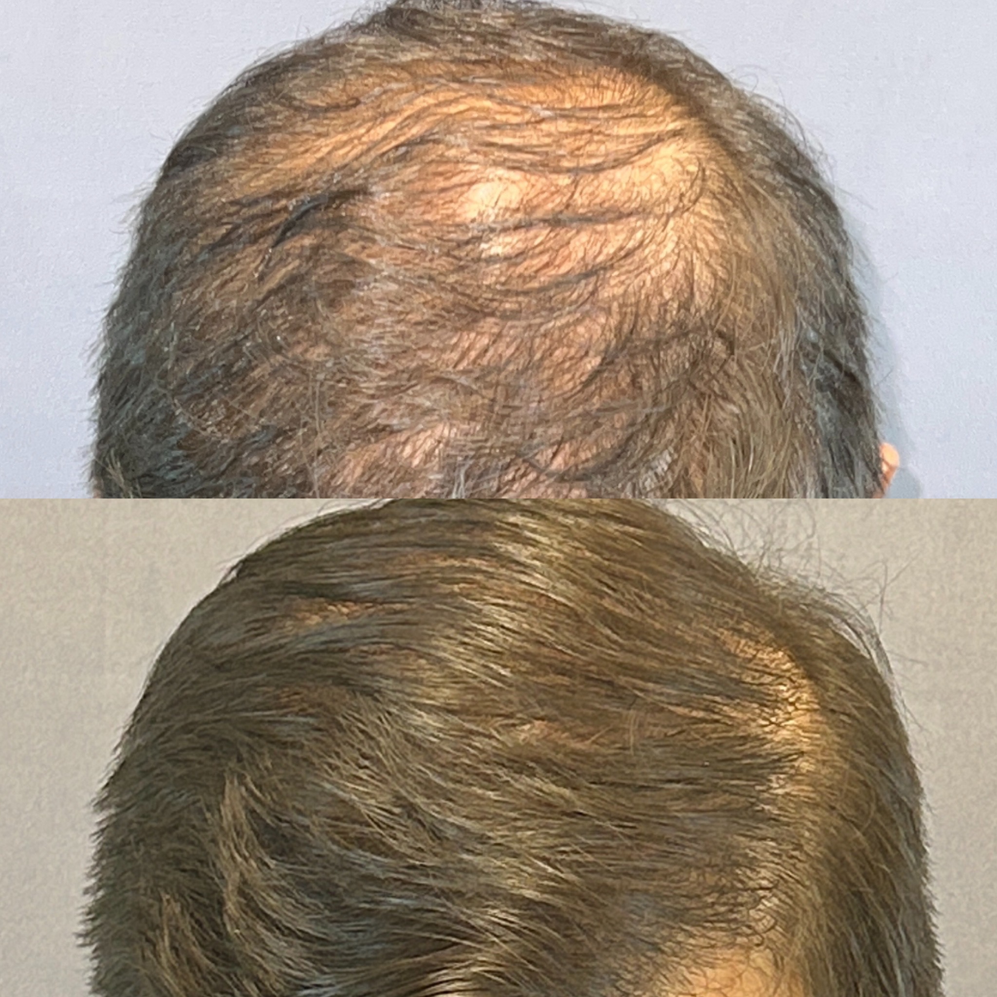 NeoGraft Austin | FUE Hair Transplant Austin