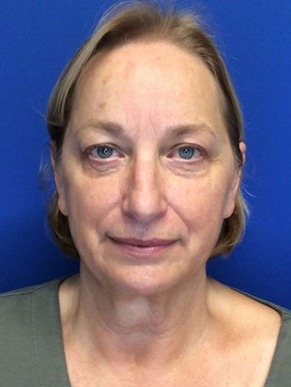 Patient 90393127 Face Lift Before And After Images Richmond Plastic