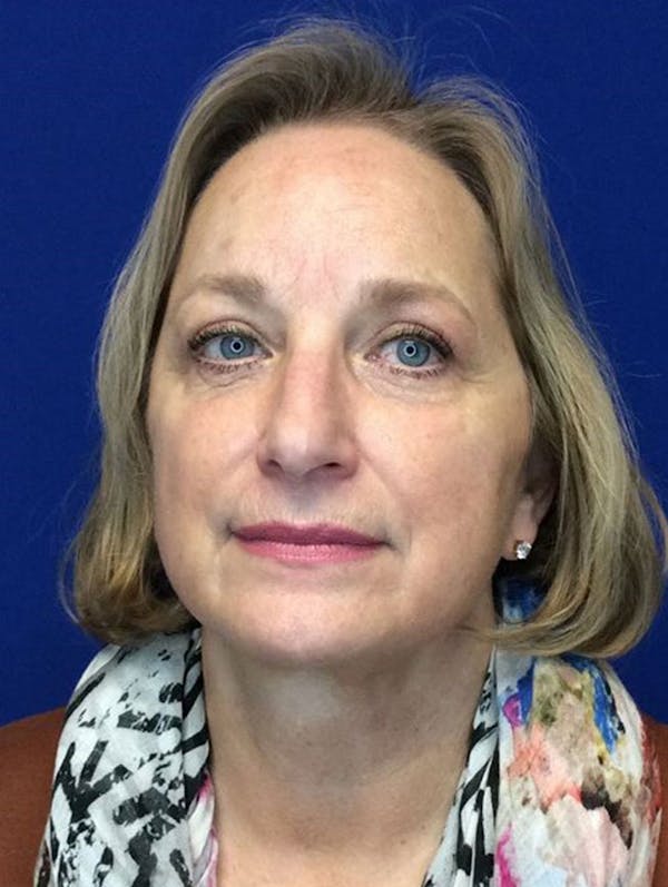 Patient 90393127 Face Lift Before And After Images Richmond Plastic