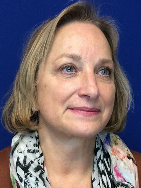 Patient 90393127 Face Lift Before And After Images Richmond Plastic