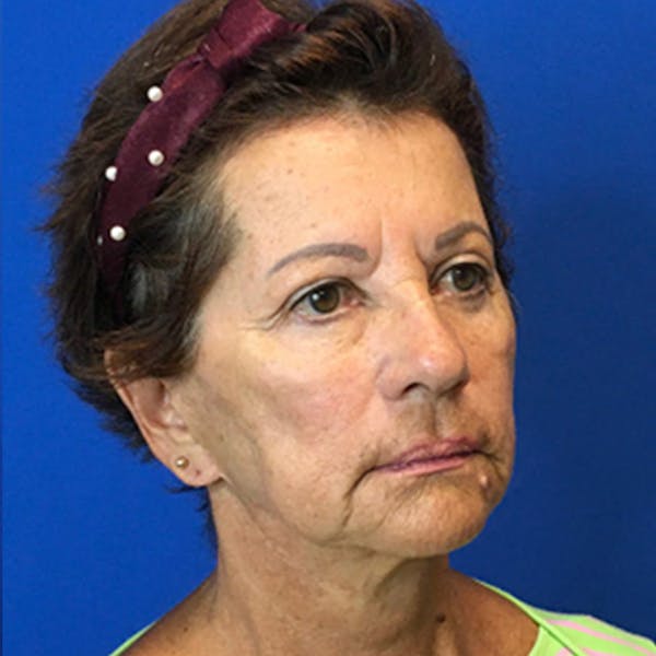 Patient 181140531 Neck Lift Before And After Images Richmond Plastic