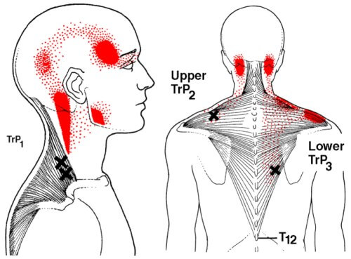 Referred Trigger Point Pain | Brookbush Institute Glossary