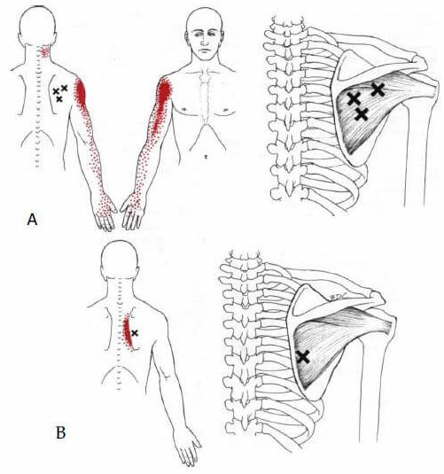 Pain Shoulder Teres Minor Rotator Cuff Arm Trigger Points Earth Round ...