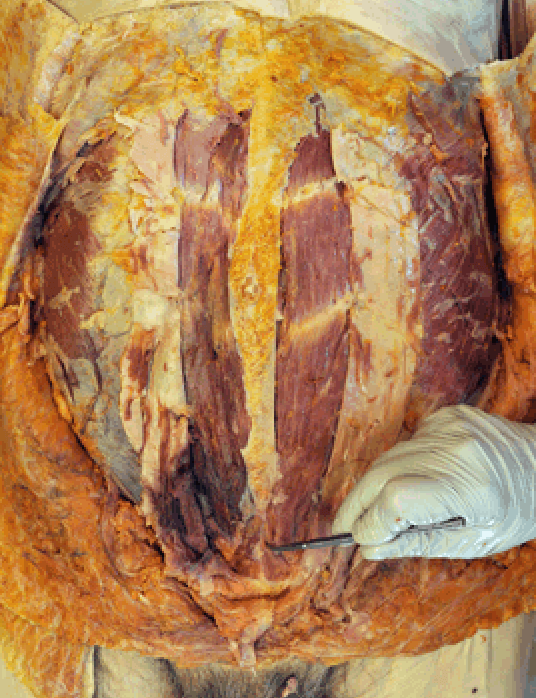 Rectus Sheath Cadaver
