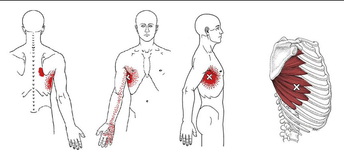 Serratus Anterior Muscle Pain