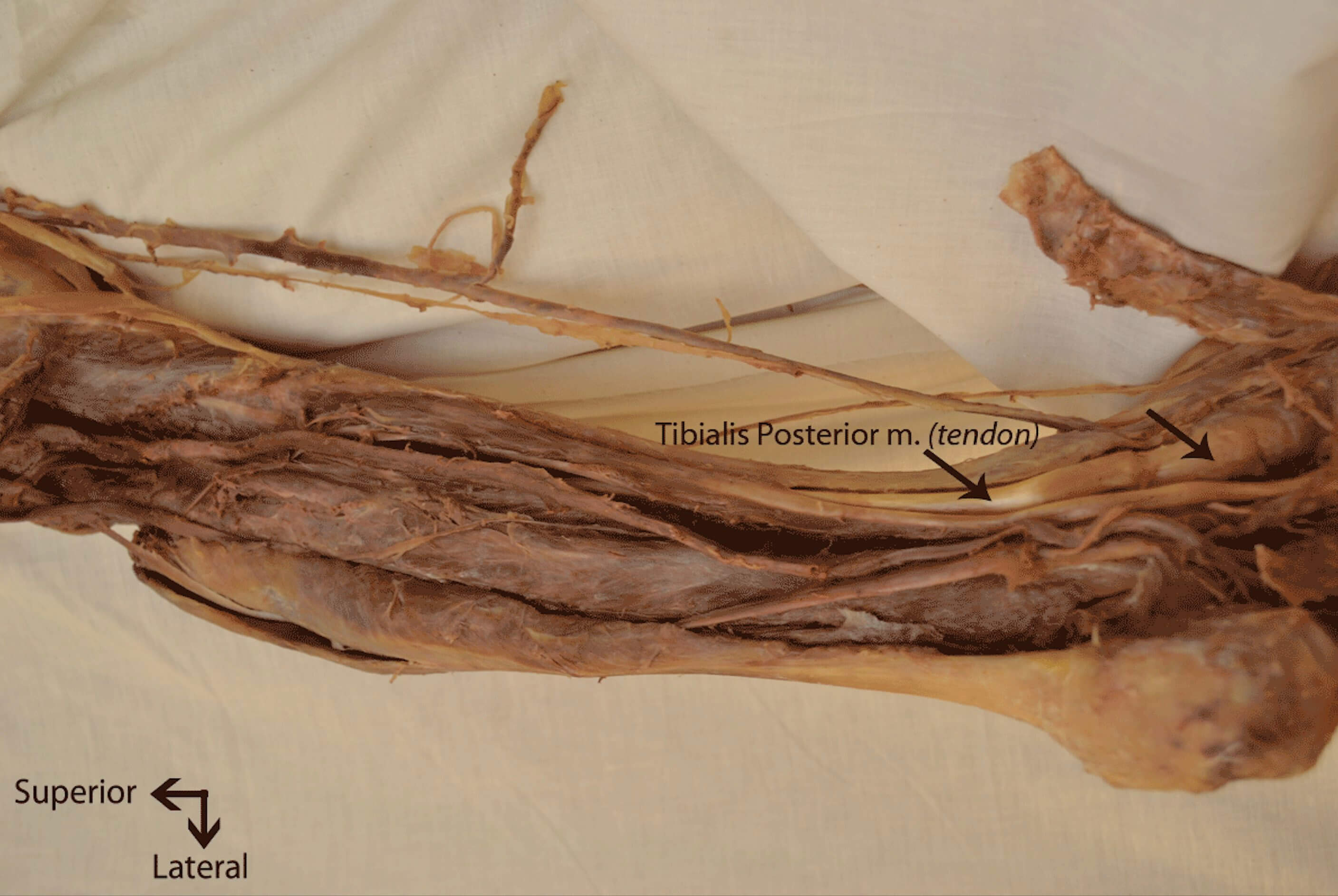 Tibialis Posterior Cadaver