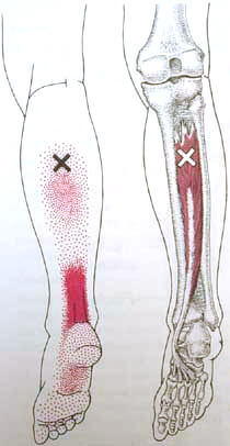 Posterior Tibialis Trigger Point