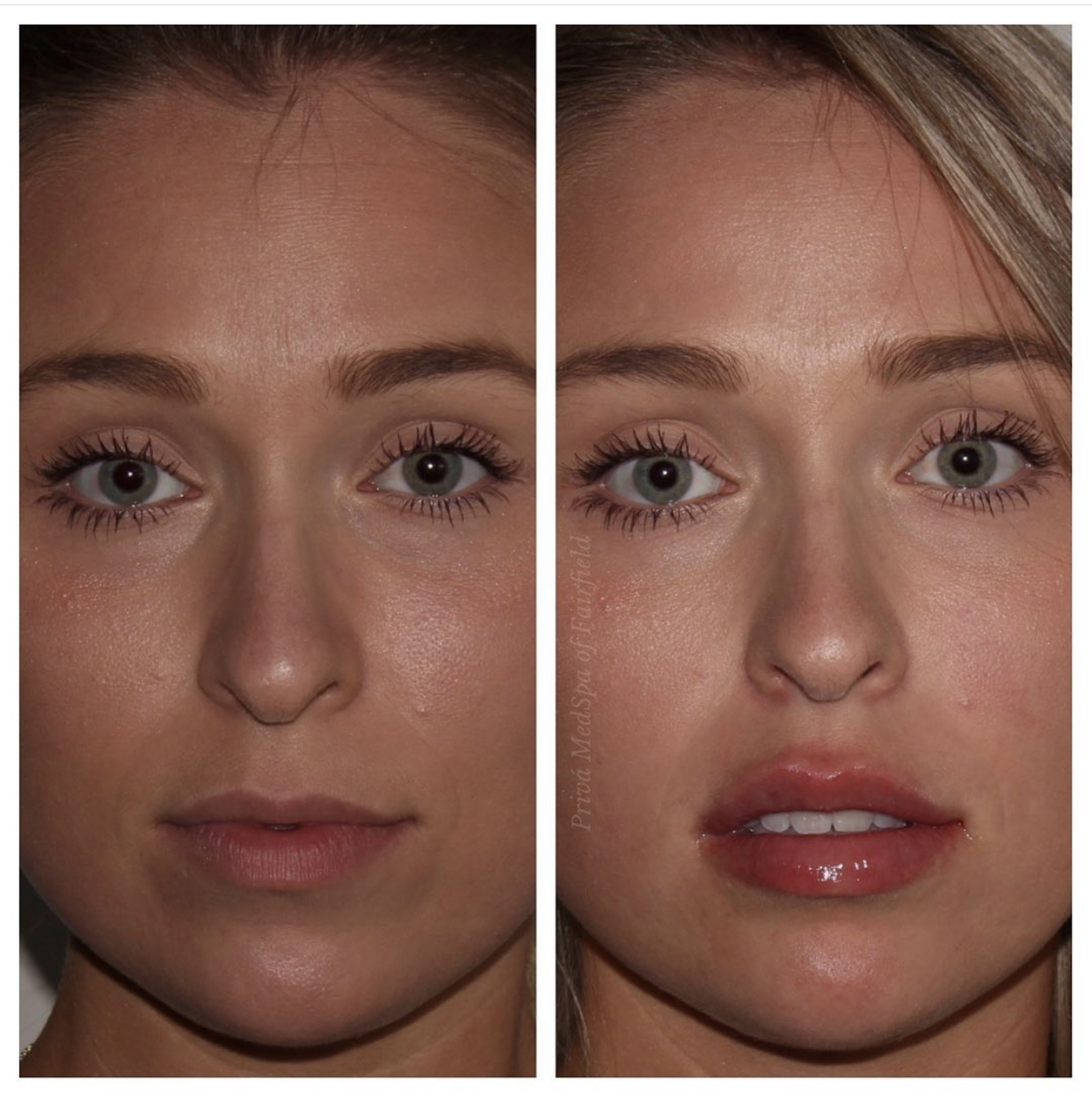 Lip Augmentation Before And After