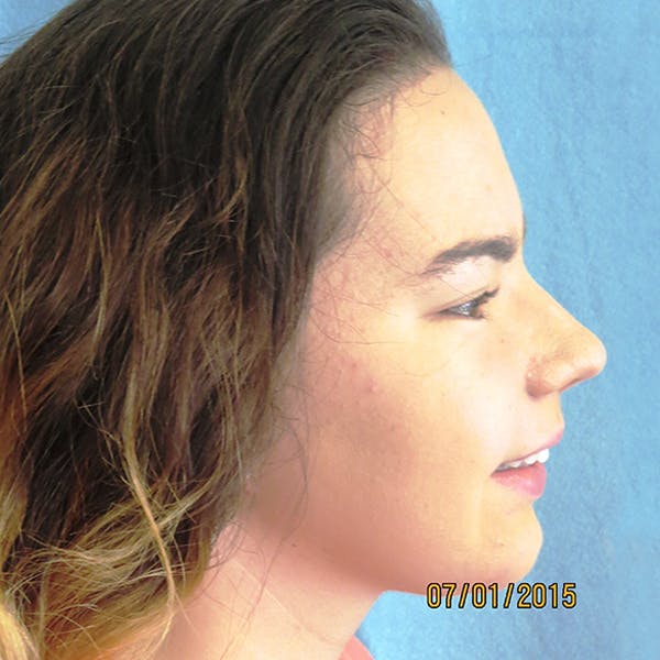 Chin Implants Ventura | Chin Surgery Santa Barbara | Genioplasty