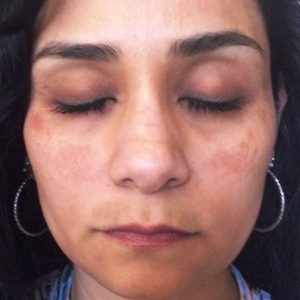 Cosmelan Before And After Gallery Dr Morrissette