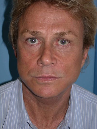 Facelift Gallery | Dr. James Anthony