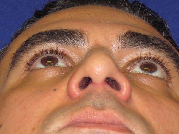 Septoplasty Philadelphia, Deviated Septum Correction Cherry Hill, Nose ...