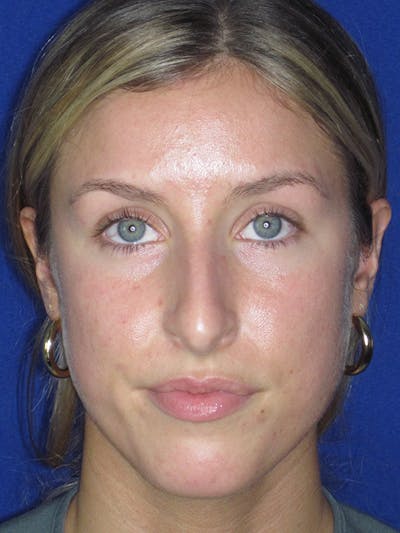 Patient 165416667 Rhinoplasty Gallery Dr Anthony Corrado