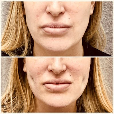 B&A Dimpleplasty Gallery | Dr. Hardik Doshi in Brooklyn